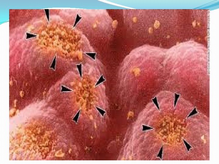 7 Secrets That Break the Lyme Disease Curse