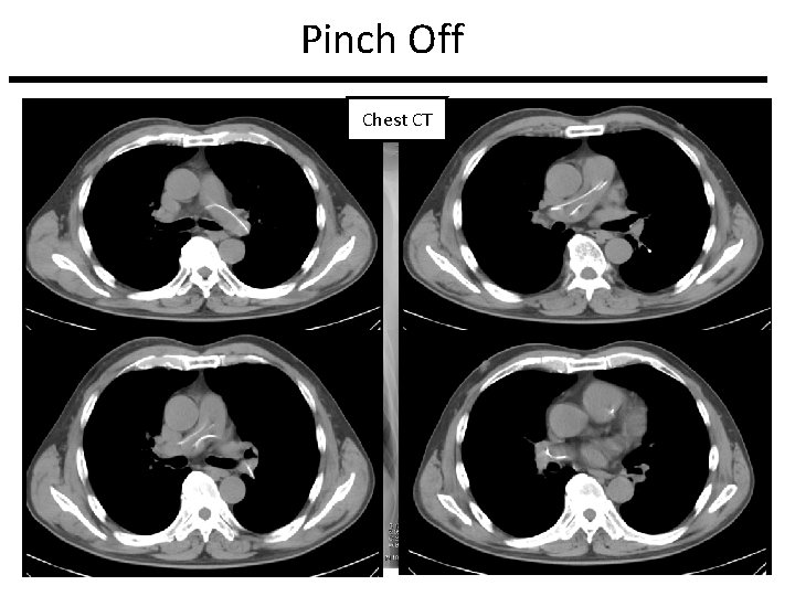 Attention of cancer care for totally implantable venousaccess