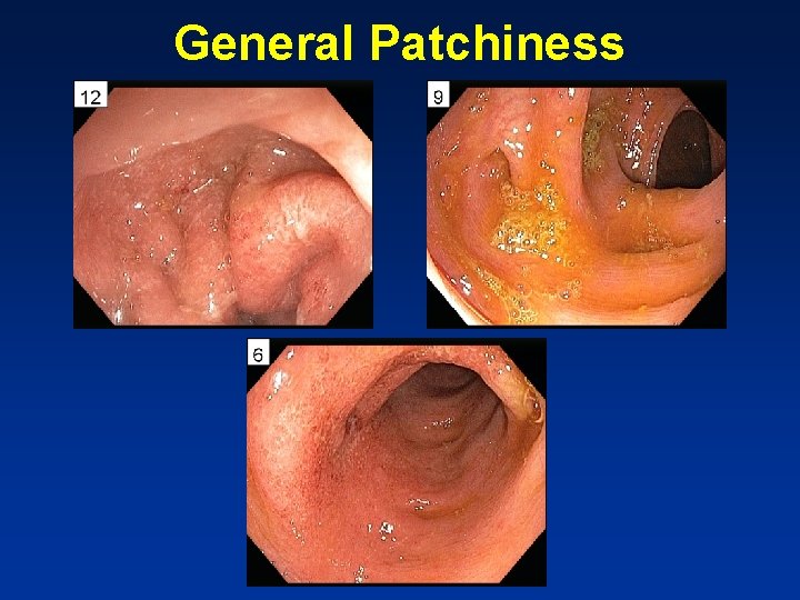 How Do We Make the Diagnosis of IBD