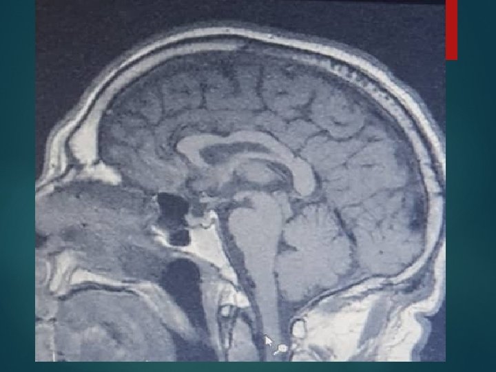Acromegaly case study Present illness A 57 year