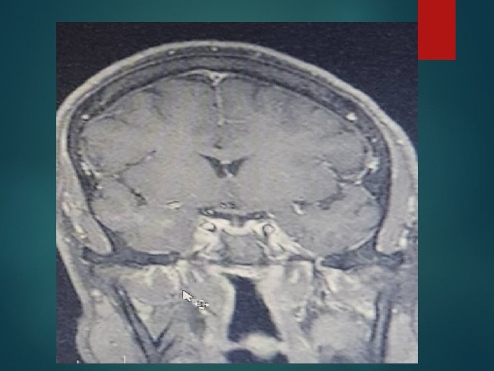 Acromegaly case study Present illness A 57 year