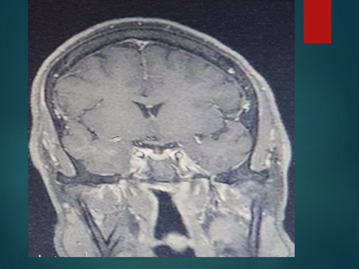 Acromegaly case study Present illness A 57 year