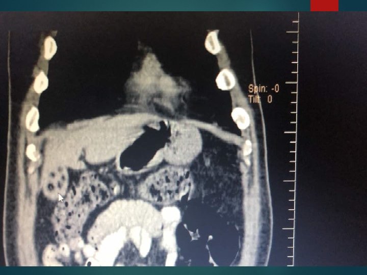 Acromegaly case study Present illness A 57 year