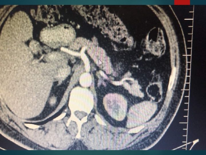 Acromegaly case study Present illness A 57 year