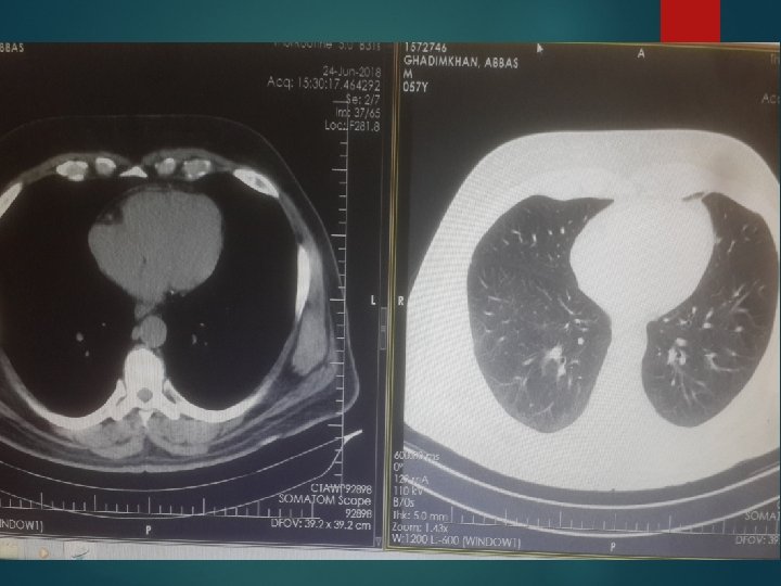 Acromegaly case study Present illness A 57 year