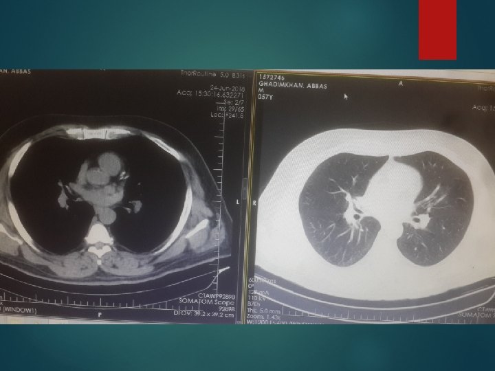 Acromegaly case study Present illness A 57 year