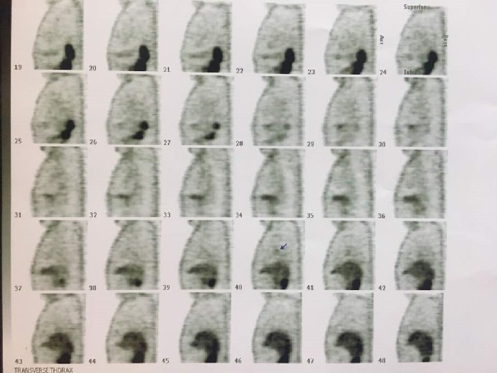 Acromegaly case study Present illness A 57 year