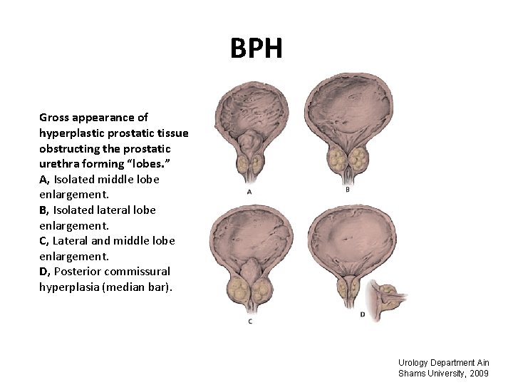 Benign Prostatic Hyperplasia BPH Urology Department Ain Shams