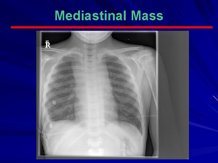 Asthma Masqueraders Differential Diagnosis in Children and Teens