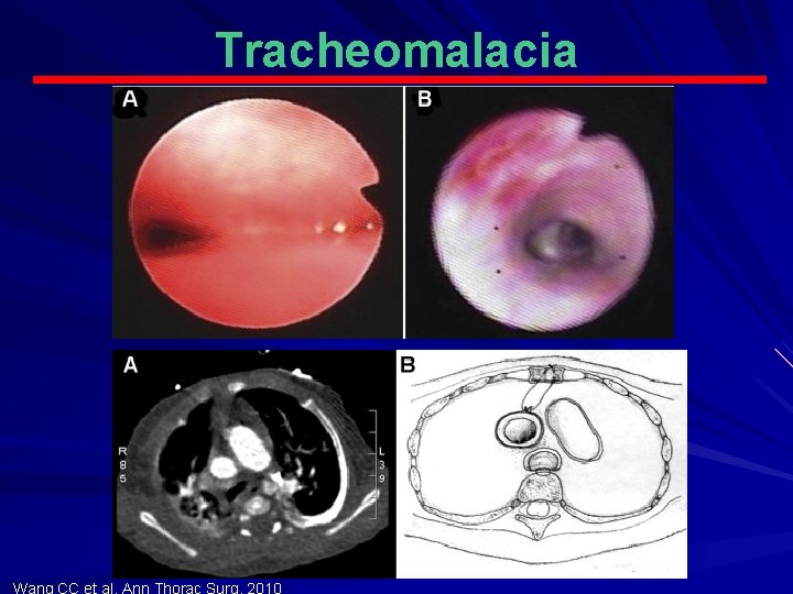 Asthma Masqueraders Differential Diagnosis in Children and Teens