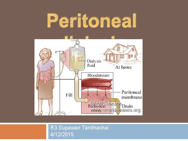 Peritoneal dialysis R 3 Supawan Tantihachai 4122015 OUTLINE