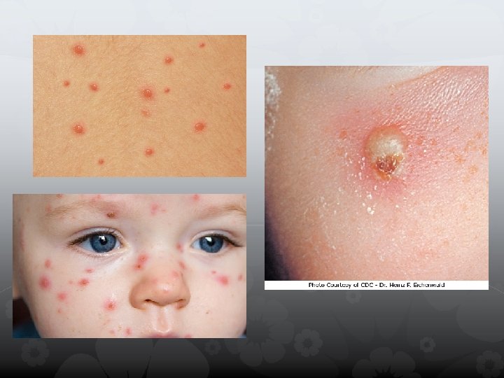 Paediatric Emergency Medicine Infections Sepsis Exanthemata Diane ...