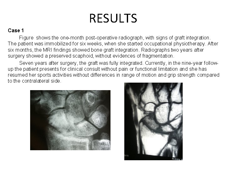 Treatment of Preiser disease with vascularized bone graft