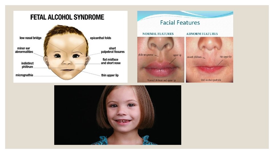 FETAL ALCOHOL SYNDROME By Meghan Grill Introduction Fetal