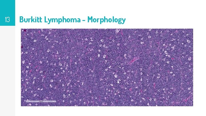 2 Neoplastic Proliferations of White Cells Lymphoid Neoplasms