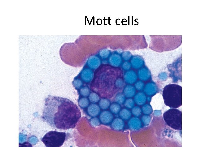 Plasma Cell Neoplasms and Related Disorders These Bcell