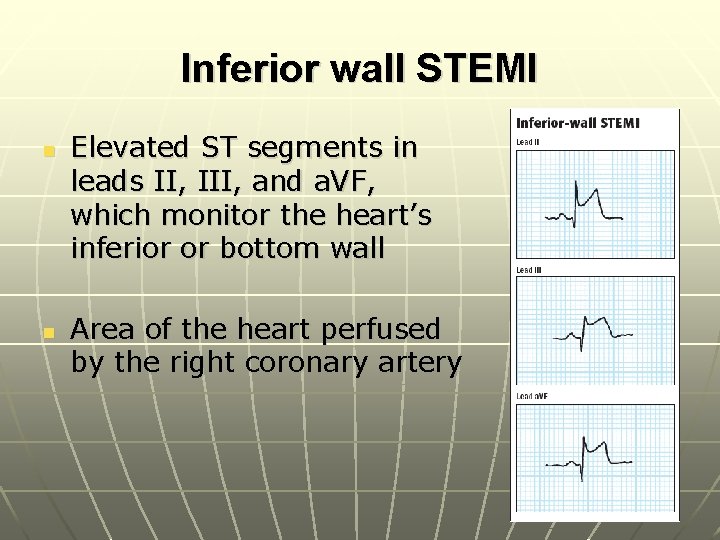 Understanding the 12 lead ECG part II By