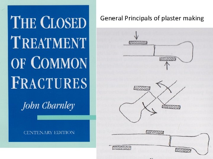 Application of below knee back slab V Kubaitis