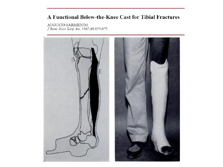 Application of below knee back slab V Kubaitis
