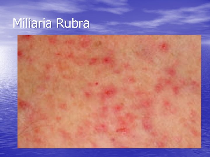 Miliaria Miliaria merupakan suatu bentuk yang umum untuk