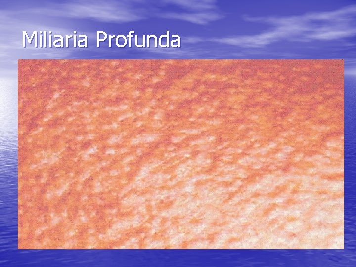 Miliaria Miliaria merupakan suatu bentuk yang umum untuk