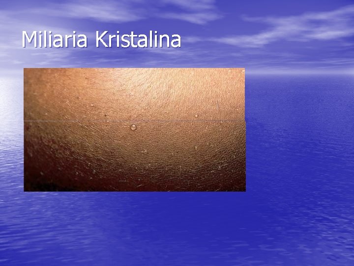 Miliaria Miliaria merupakan suatu bentuk yang umum untuk