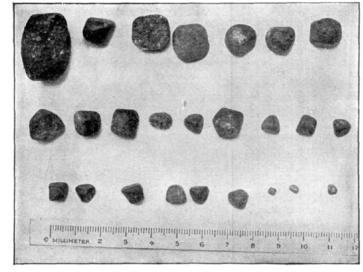 Gall Stones Cholelithiasis Cholelithiasis Definition Most common biliary
