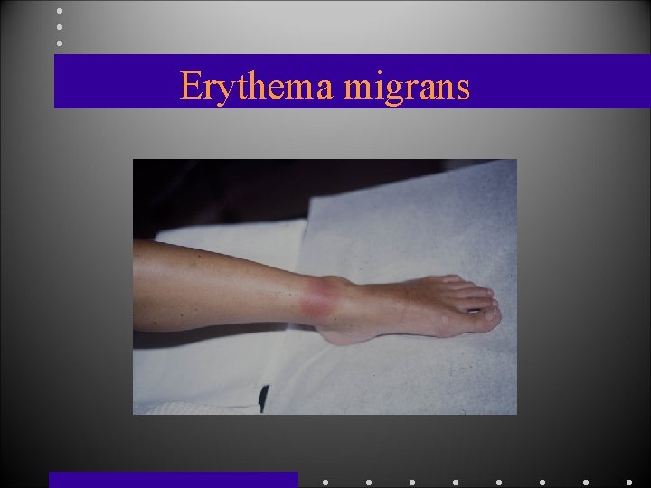 LYME BORRELIOSIS LYME BORRELIOSIS Old Lyme Connecticut USA