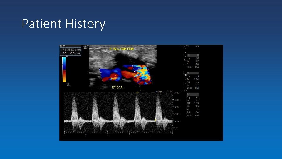 Transradial Approach for Common Femoral Artery Intervention Involving