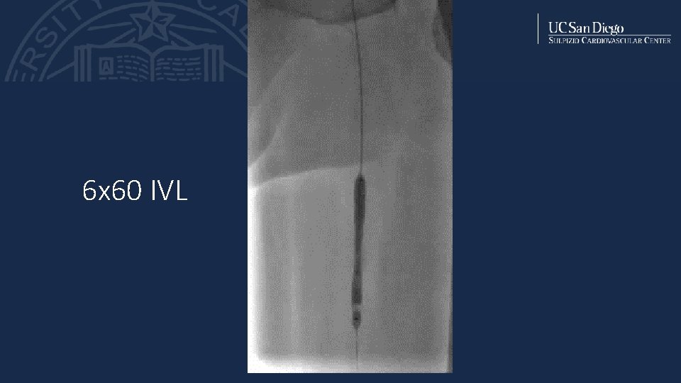 When 20 ATM Just Isnt Enough The Nondilatable