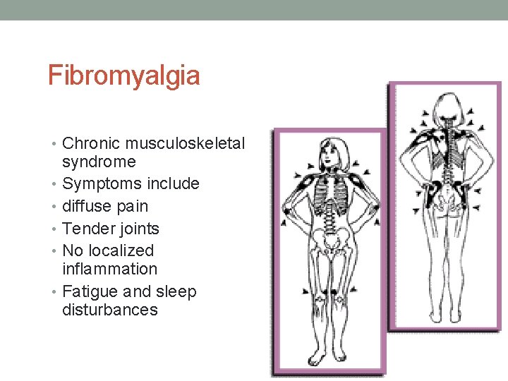 PATHOPHYSIOLOGY Skeletal and Muscular Pathophysiology Terms Sprain ligament