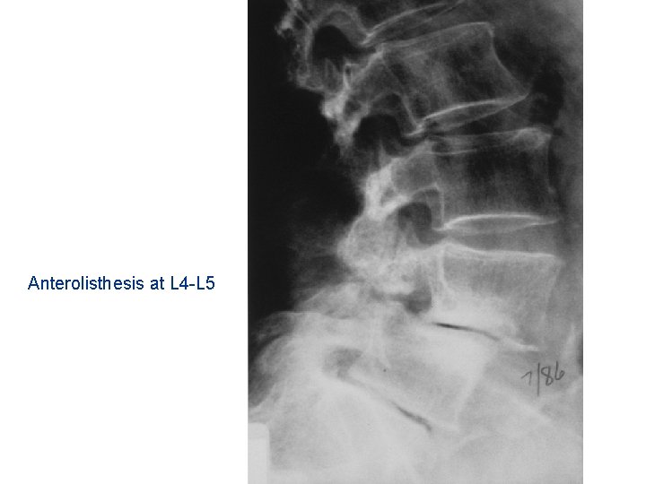 BACK PAIN AND LUMBAR STENOSIS IN OLDER ADULTS