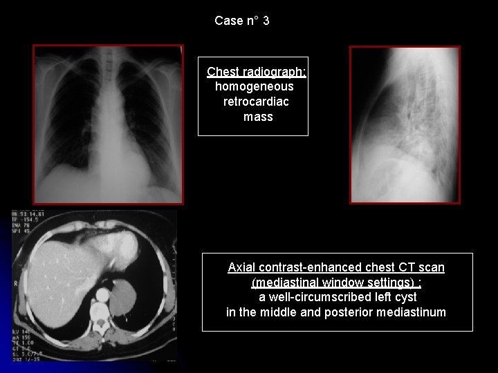 CH 2 MEDIASTINAL BRONCHOGENIC CYSTS OF ADULTS Report