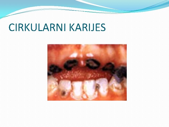 STOMATOLOKE BOLESTI KOD DECE I PREVENCIJA Kod oveka