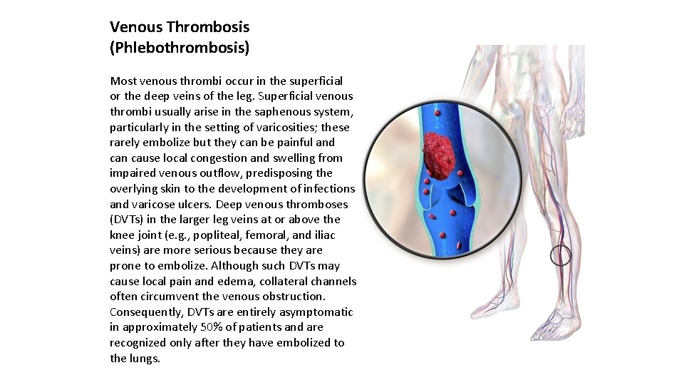 Thromboembolism and Shock Mural thrombi A Thrombus in