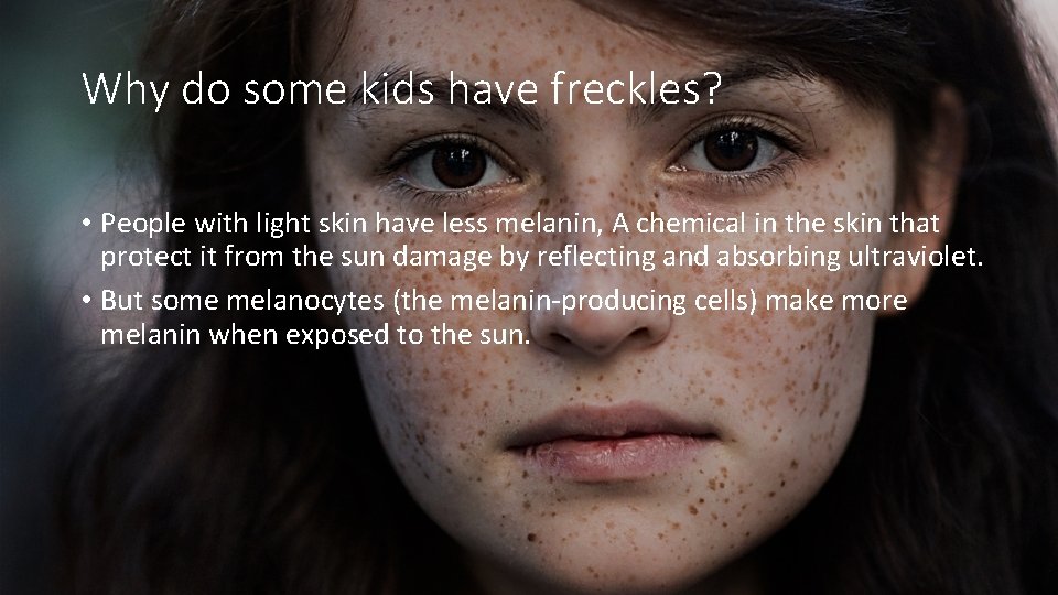 Why do we have freckles By Sydney Why