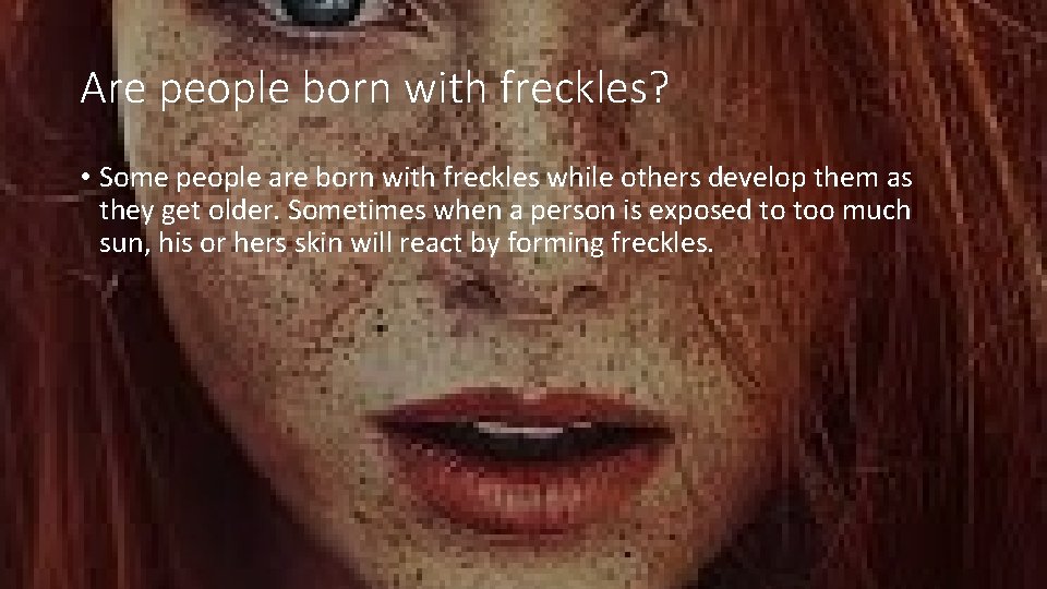 Why do we have freckles By Sydney Why