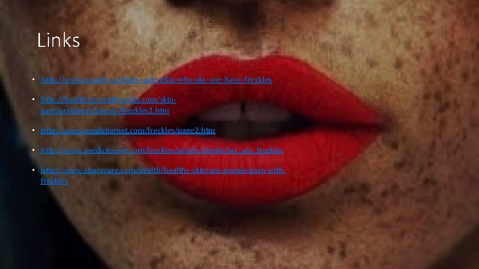 Why do we have freckles By Sydney Why