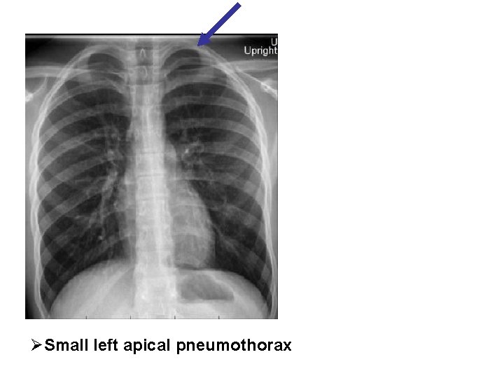 Recurrent Pneumothorax 2232011 17 year old boy Recurrent