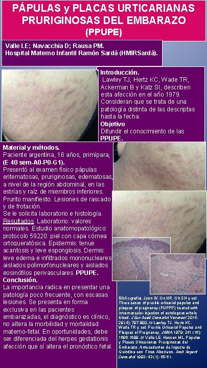 PPULAS y PLACAS URTICARIANAS PRURIGINOSAS DEL EMBARAZO PPUPE