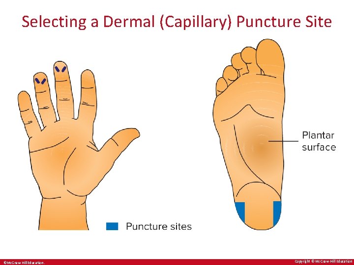 Dermal Capillary Puncture Chapter 10 Mc GrawHill Education
