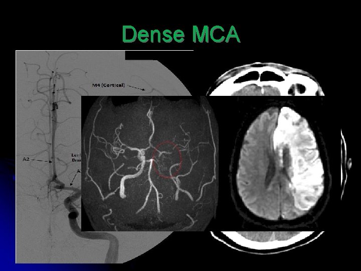 Imaging in Stroke A Rational Approach to acute