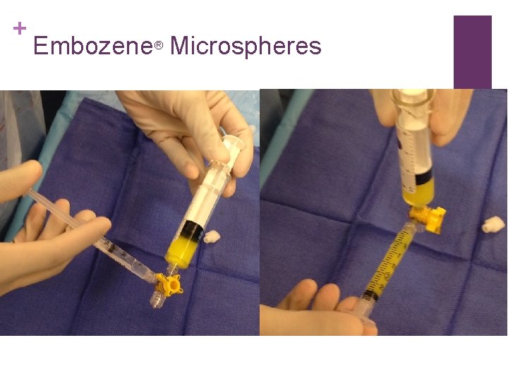 Prostate Artery Embolization Sandeep Bagla MD Cardiovascular Interventional