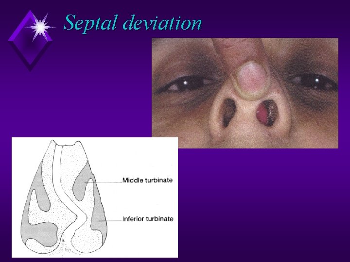 NASAL OBSTRUCTION Blocked Nose Lt Col Mian Amer