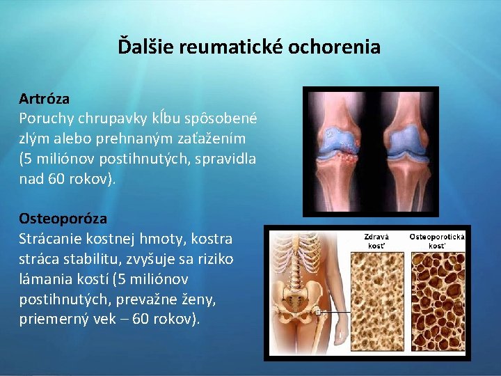 REUMA Zkladn charakteristika jedna z najrozrenejch udovch chorb