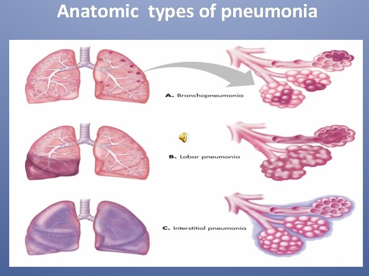 Pneumonia By Dr Kritika Joshi MD kaumarbhritya Assistant