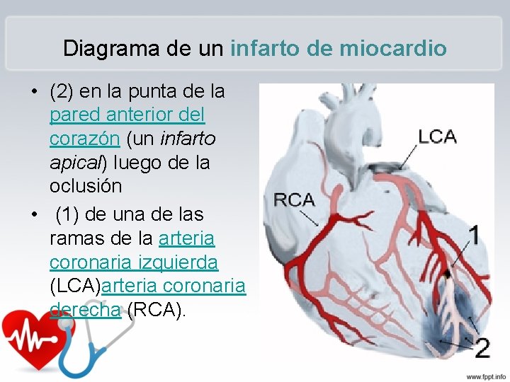 INFARTO AGUDO DE MIOCARDIO ENF MARTA BAEZA MANJARREZ