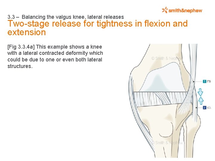 Ligament Balancing in Total Knee Arthroplasty Section 3