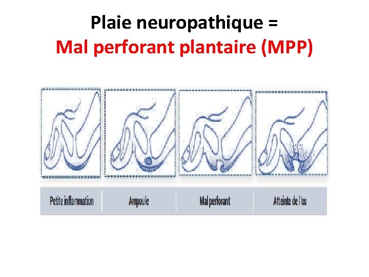 Conduite tenir devant Un pied diabtique CAS clinique