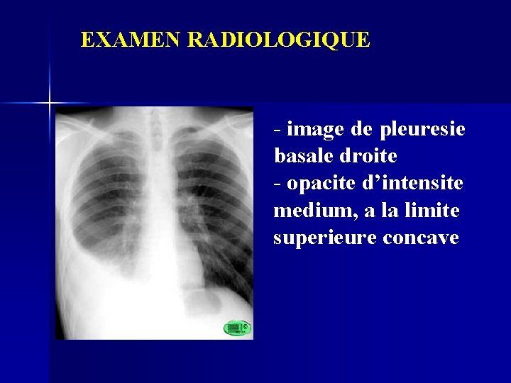 Diagnostic de la pleuresie tuberculeuse Diagnostic clinique v